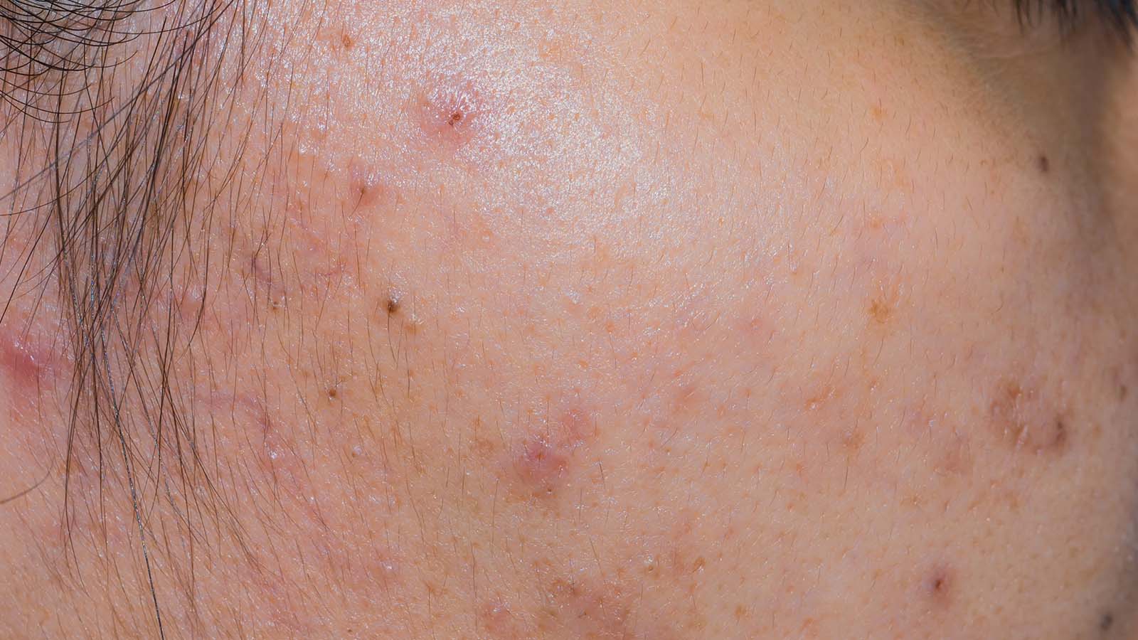 Why Do I Have Red Spots On My Face Not Acne Reddit Infoupdate Why Do I Have Red Spots On My Face Not Acne Reddit Infoupdate